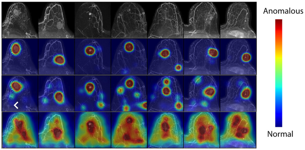 AI Model from Microsoft and University of Washington Maps Out Breast ...